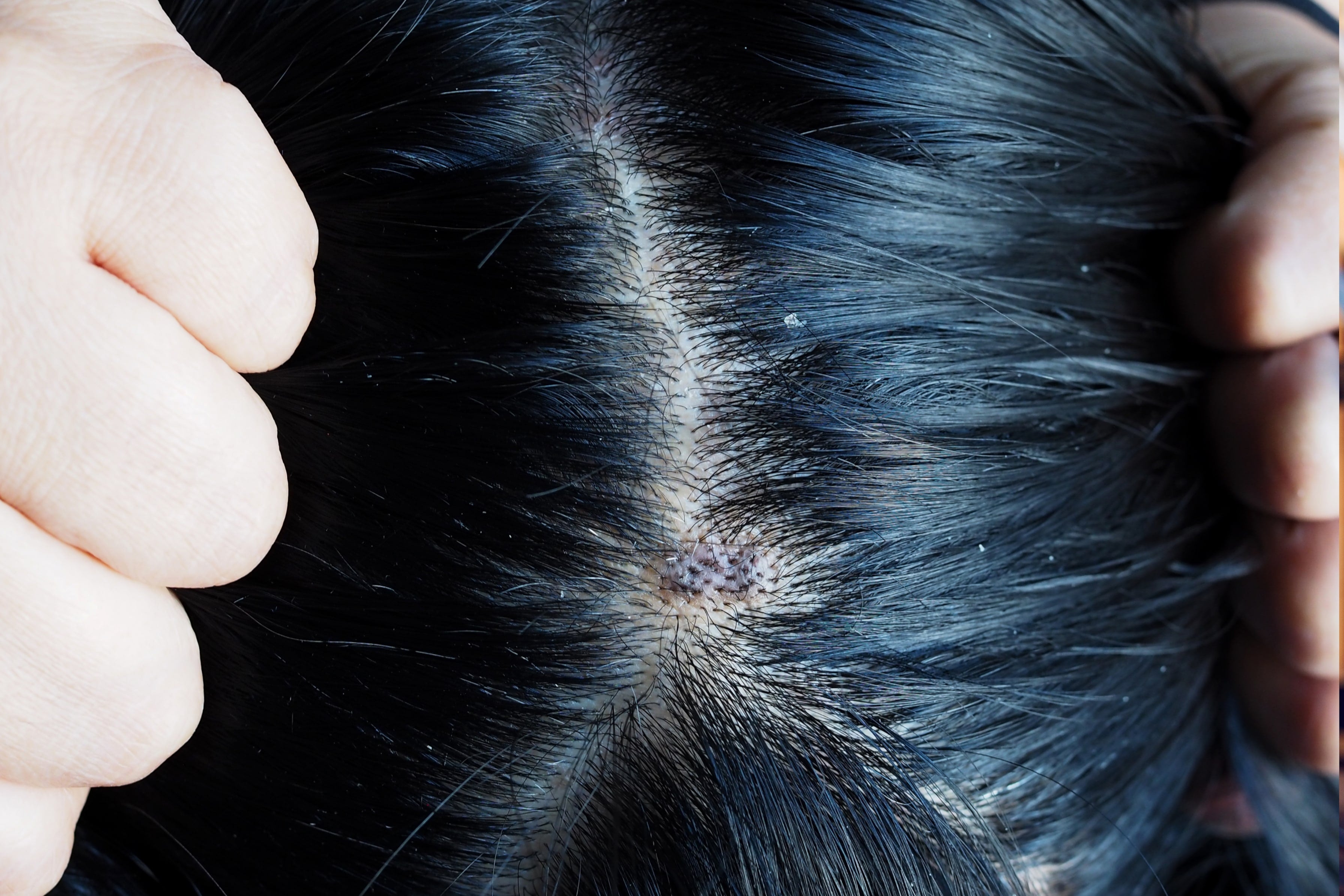 ¿Qué Es la Caspa y Por Qué Se Produce? | DS Labs – DS Laboratories - Mexico