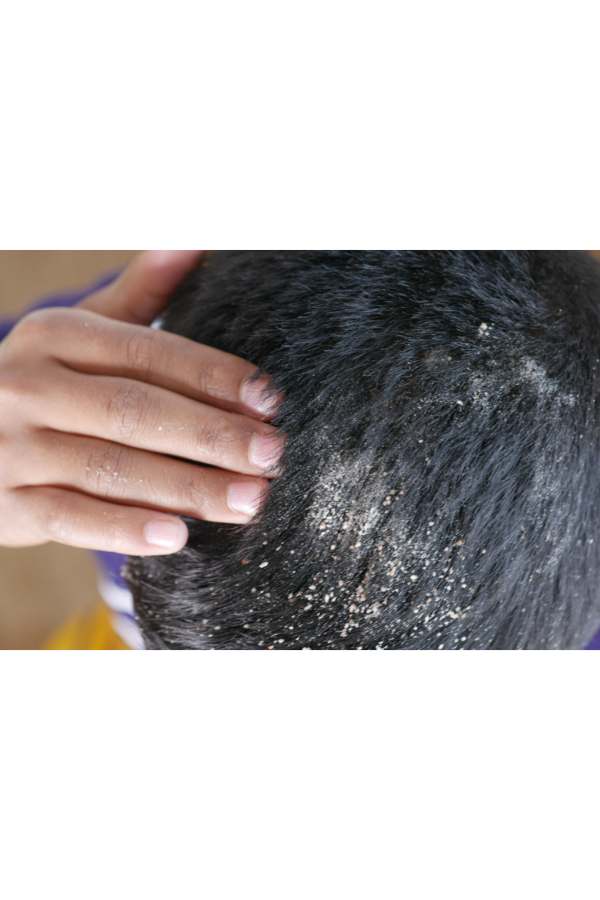 Diferencia entre caspa y piel cabelluda seca – DS Laboratories - Mexico